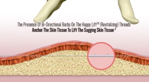 HAPPY LIFT™ Thread FACE LIFT - Xeoul Clinic