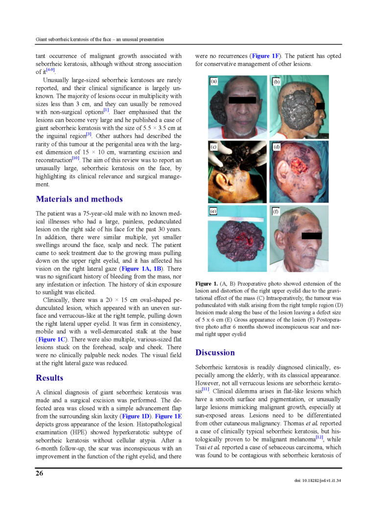 Giant seborrheic keratosis of the face – An unusual presentation ...