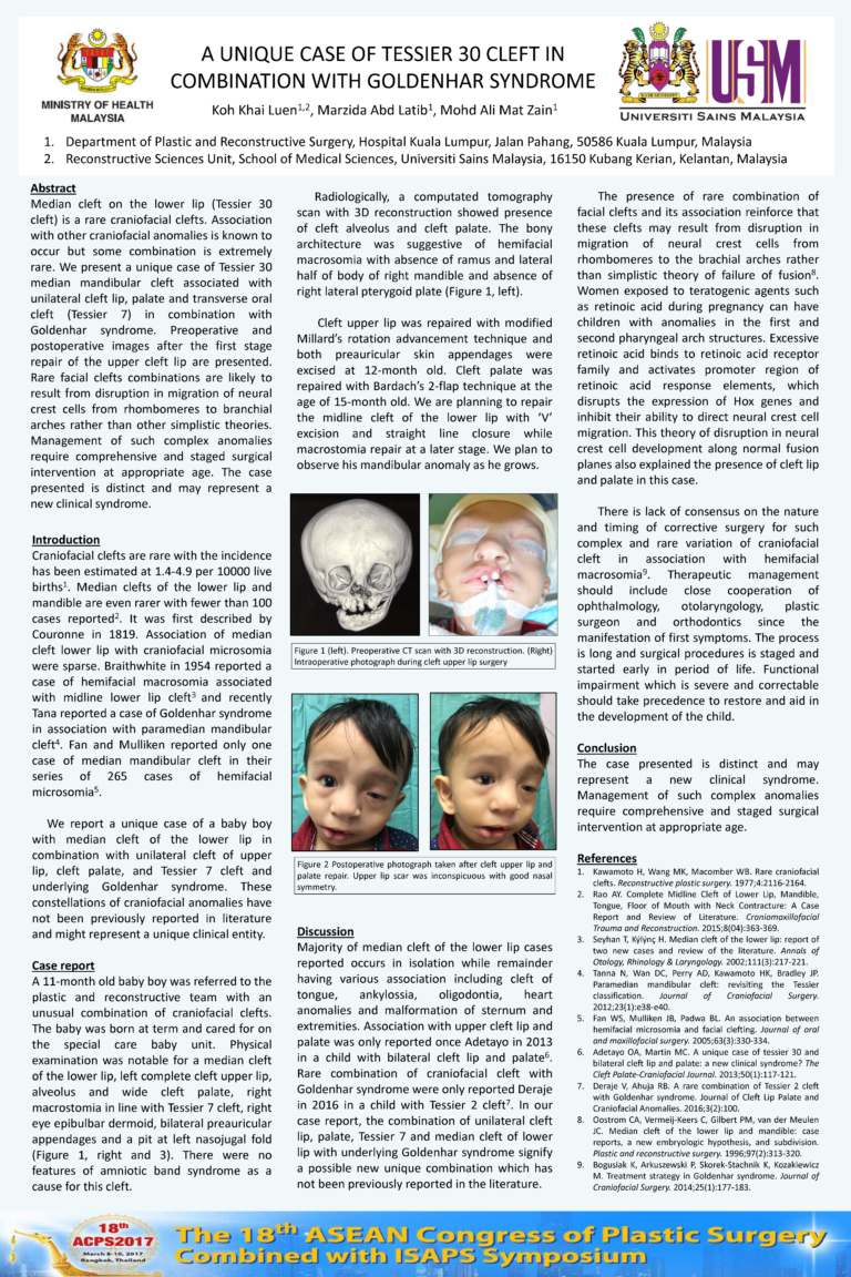 A unique case of tessier 30 cleft in combination with Goldenhar ...