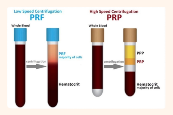 Platelet-Rich Fibrin (PRF) for Hair Restoration: A Natural Solution for ...
